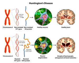 Understanding Huntington’s Disease: A Case Study for Biology